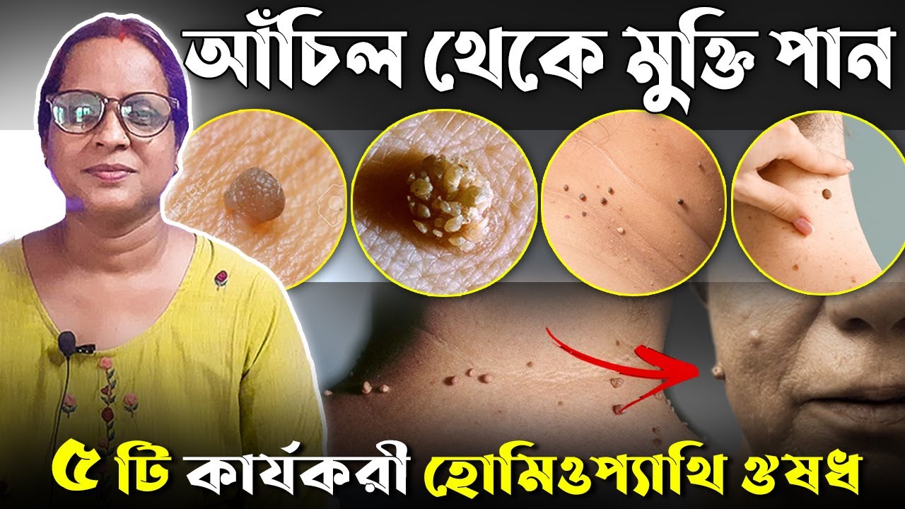 Achil Remove Bangla | আঁচিল দূর করার উপায় | আঁচিলের হোমিওপ্যাথি চিকি ...