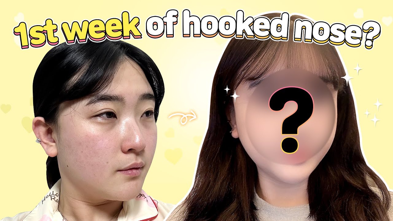 [NOSE JOB VLOG] 👍🏻Hooked nose rhinoplasty, Functional rhinoplasty at ...