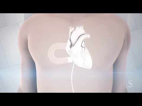 How it works: EnSite Precision cardiac mapping system - YouTube