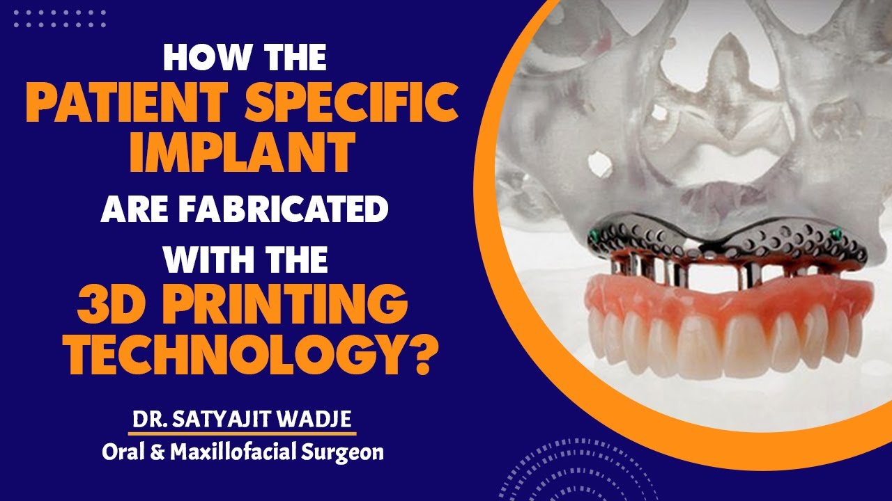 How the Patient Specific Implant are fabricated with 3D Printing ...