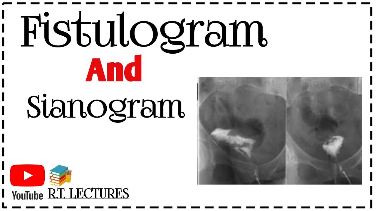 #Sianogram & Fistulogram in hindi/English #What is sianogram ...