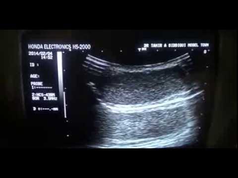 ECTOPIC inguinal region LT TESTIS - YouTube