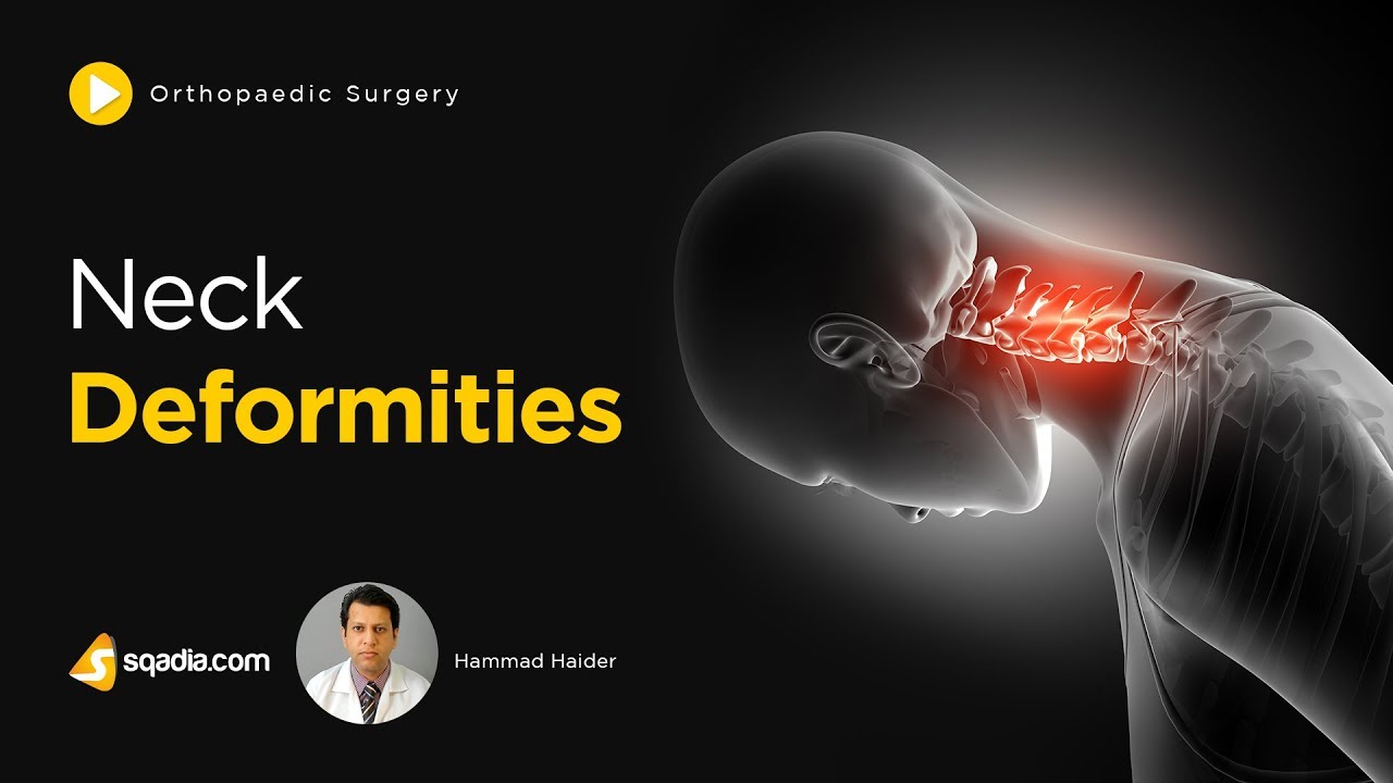 Neck Deformities | Orthopaedic Surgery Lectures | Clinical Education ...