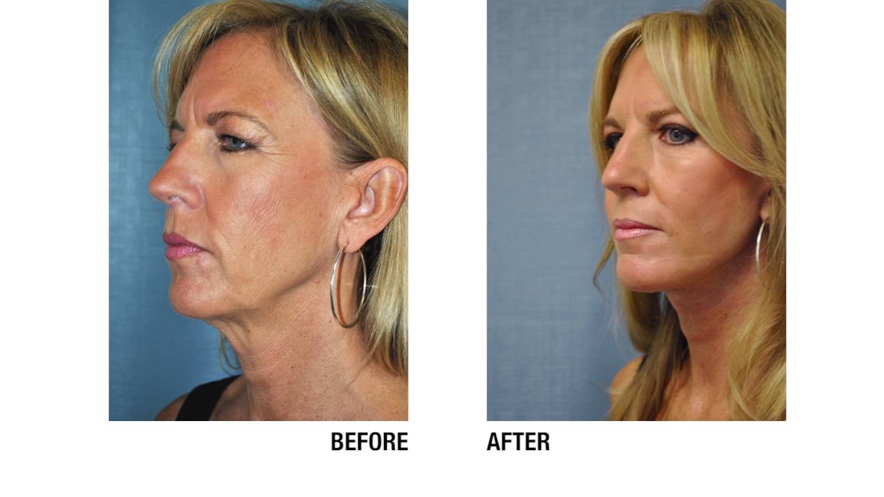 Boca Raton Facelift Surgeon | Botox Procedure | LIV Plastic Surgery ...