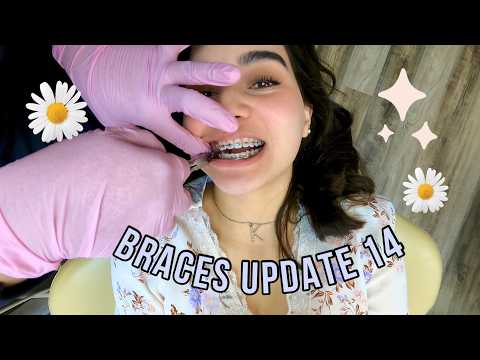 Braces Update 14 🦷 (One year & two months with braces + molar engagement)