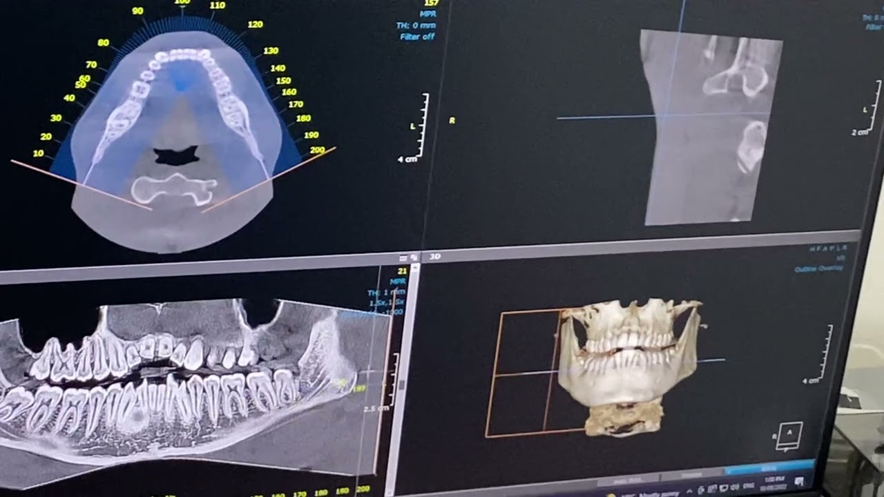 KAVO (DEXIS) OPG Pro CBCT wisdom teeth case Hawkesbury Dental - YouTube