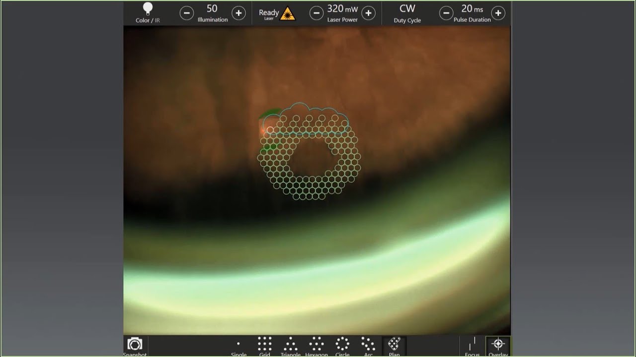 Retinopexy inferior - Mainster PRP - YouTube