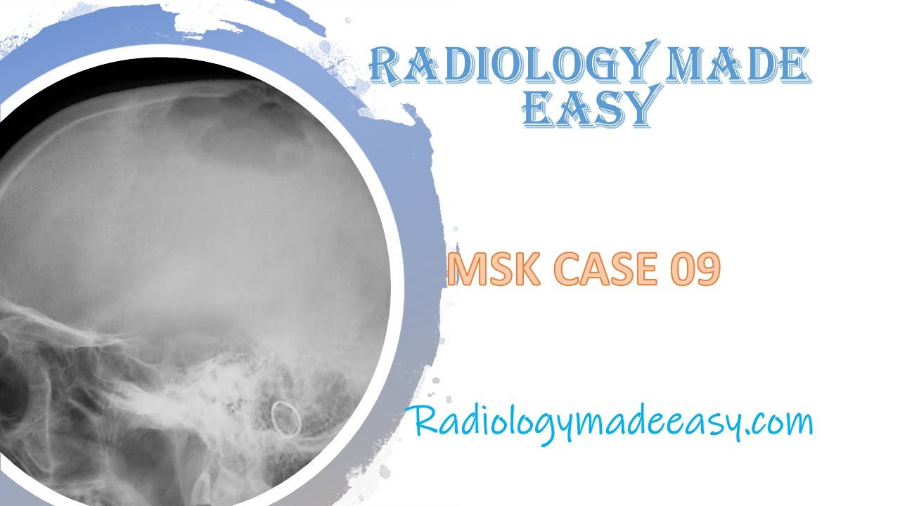 18 year old patient presented with skull lump for 6 months duration ...