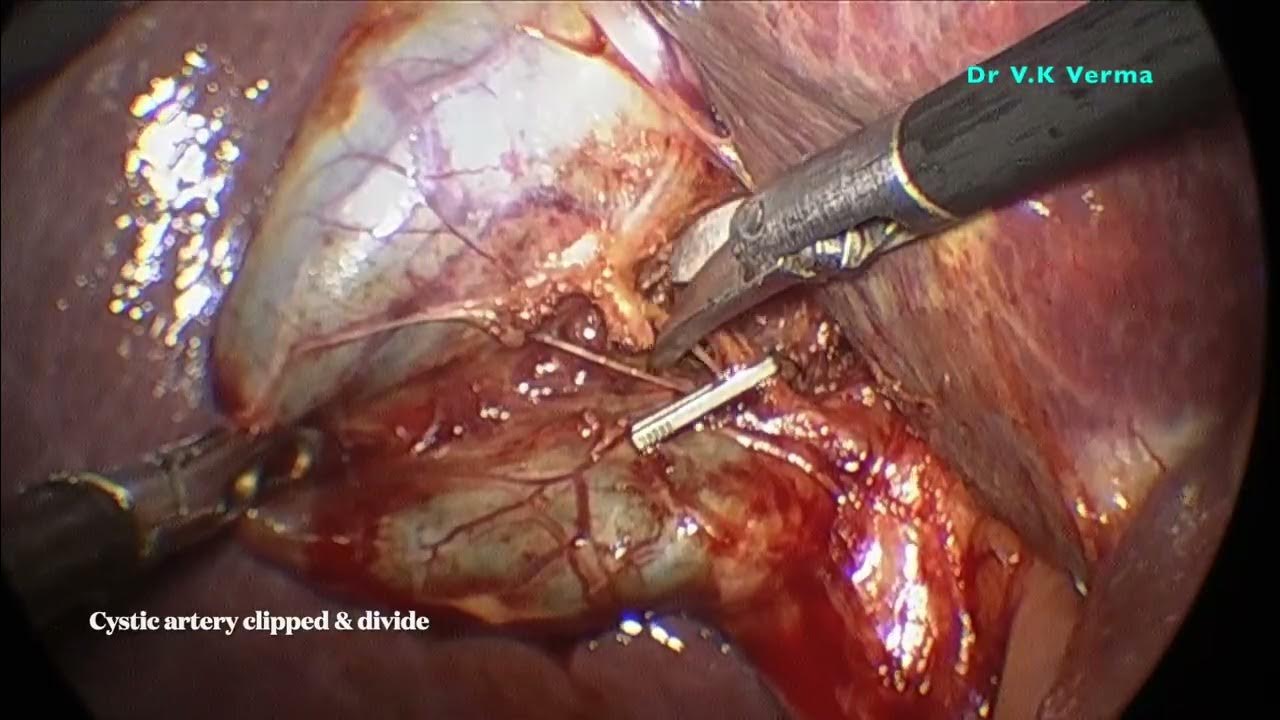 Laparoscopic Cholecystectomy - YouTube