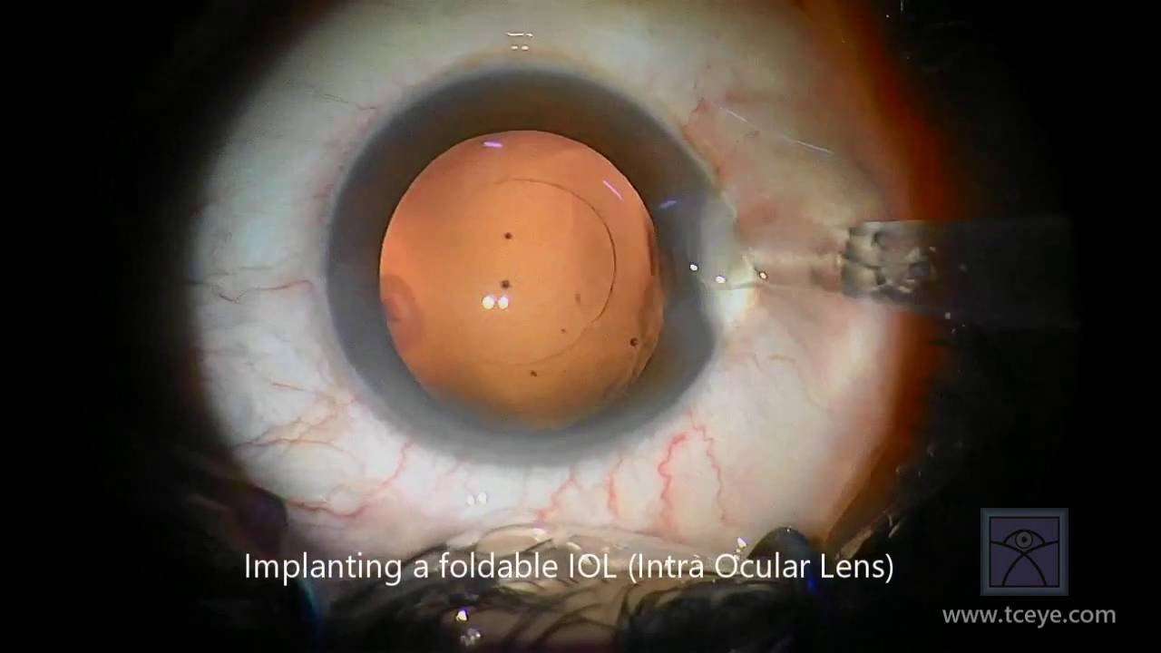 TC Eye Centre - Understanding Cataract Surgery - Dr. Upsham Goel - YouTube