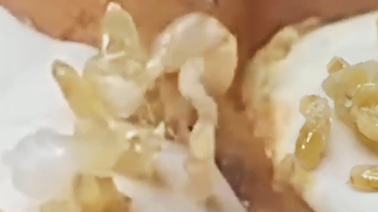 Deep blackhead extraction Cystic acne & pimple popping #15 - YouTube