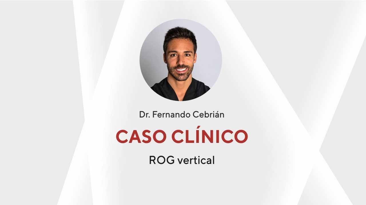 Caso clínico: ROG vertical - Dr. Fernando Cebrián - YouTube