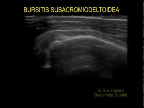 Bursitis subacromiodeltoidea - YouTube