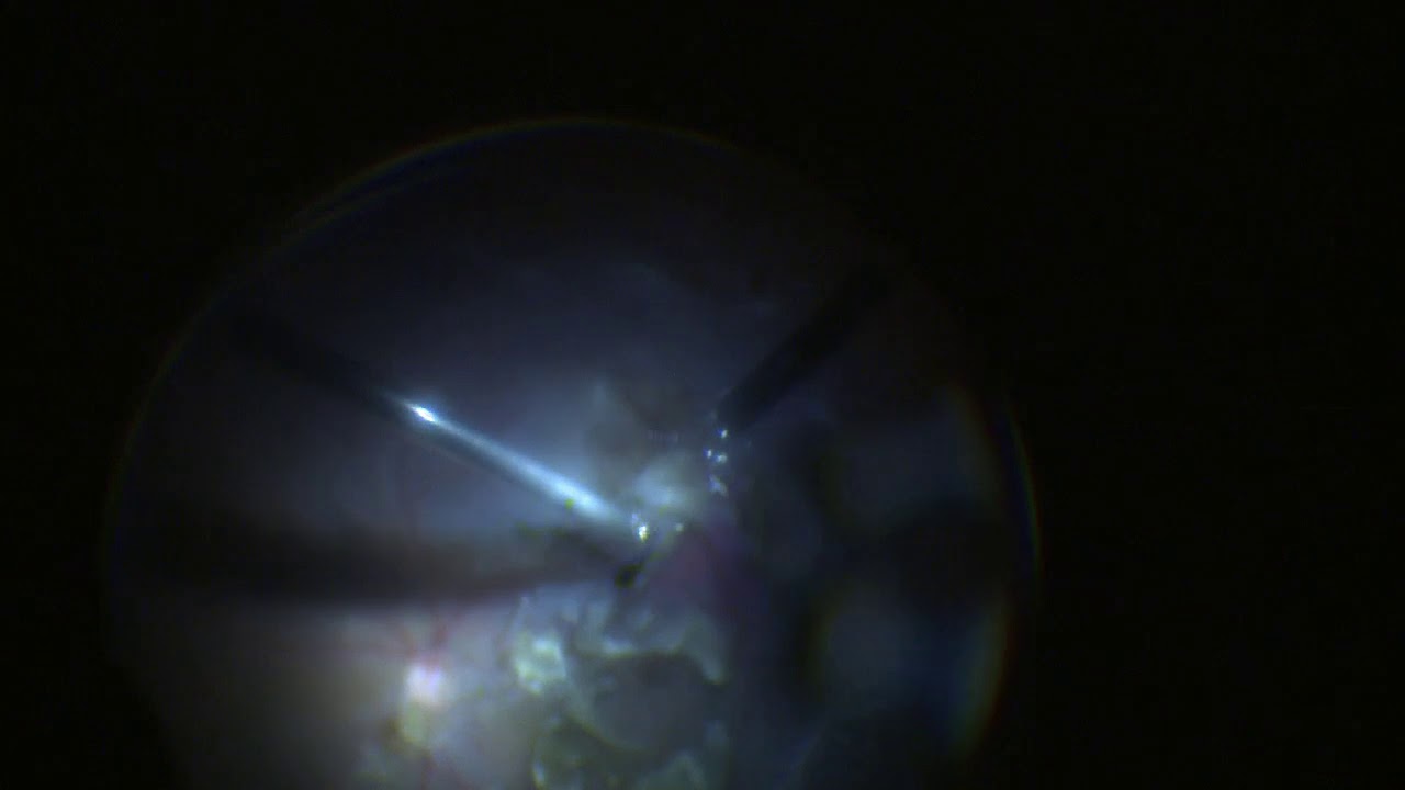 lensectomy with TDC cutter - YouTube