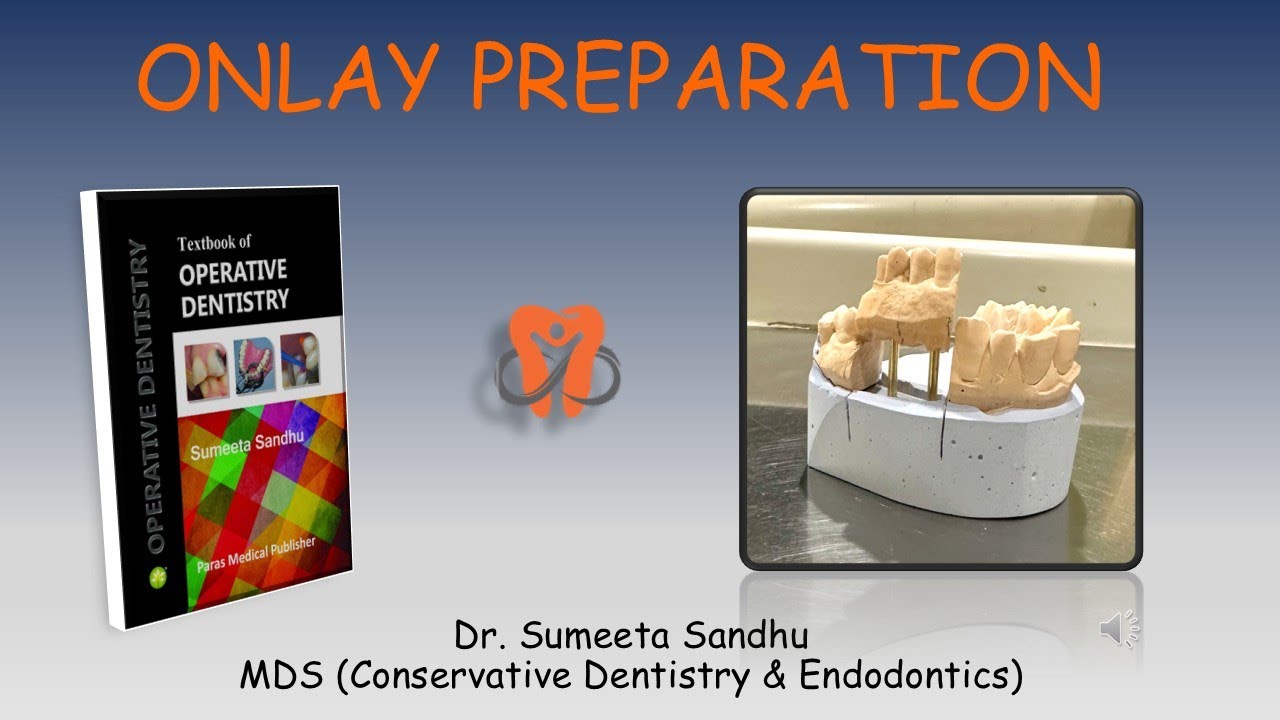 Tooth Onlay Preparation| Inlay Onlay preparation - YouTube