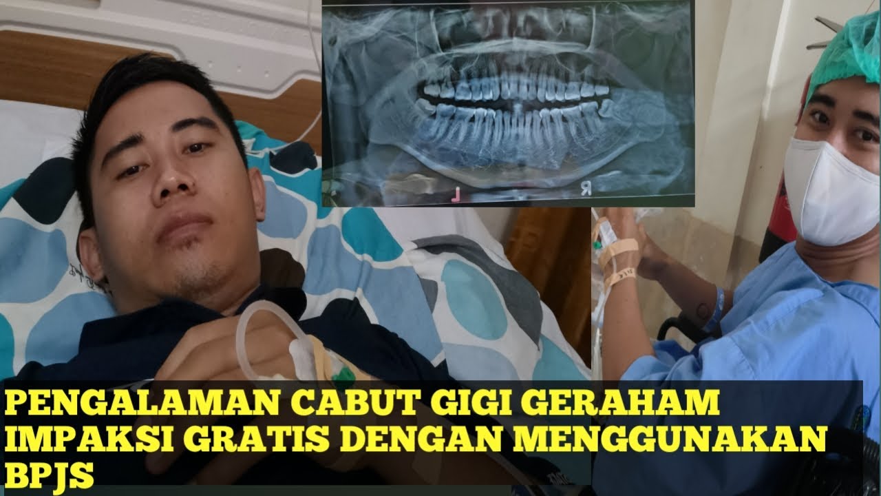 PENGALAMAN CABUT GIGI GERAHAM BUNGSU IMPAKSI SECARA GRATIS DI RUMAH SAKIT MENGGUNAKAN BPJS - YouTube