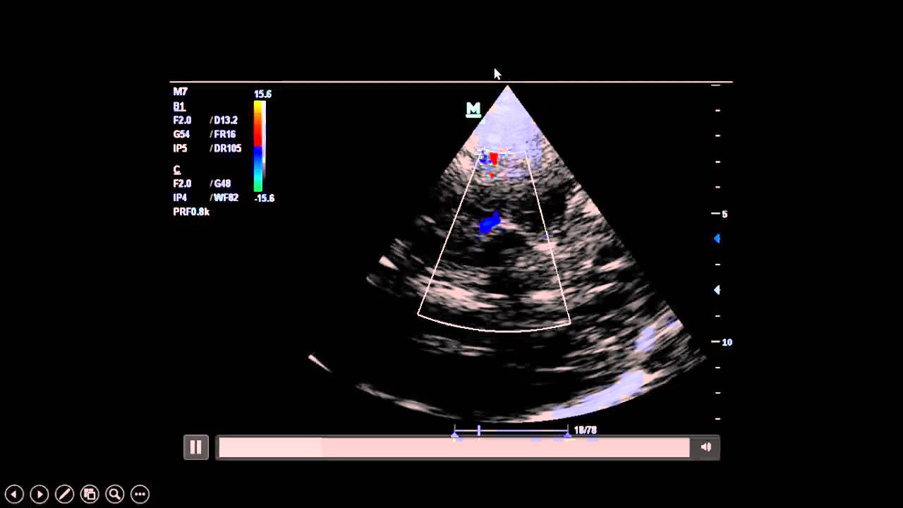 the complete story [How to do transcranial doppler step by step ...