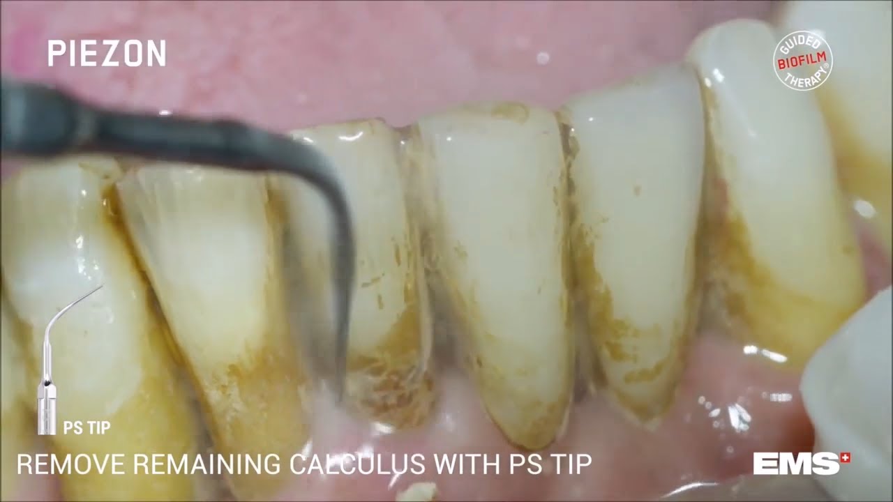 Étape 6 de la GBT : éliminer le tartre avec l'instrument PIEZON® PS ...