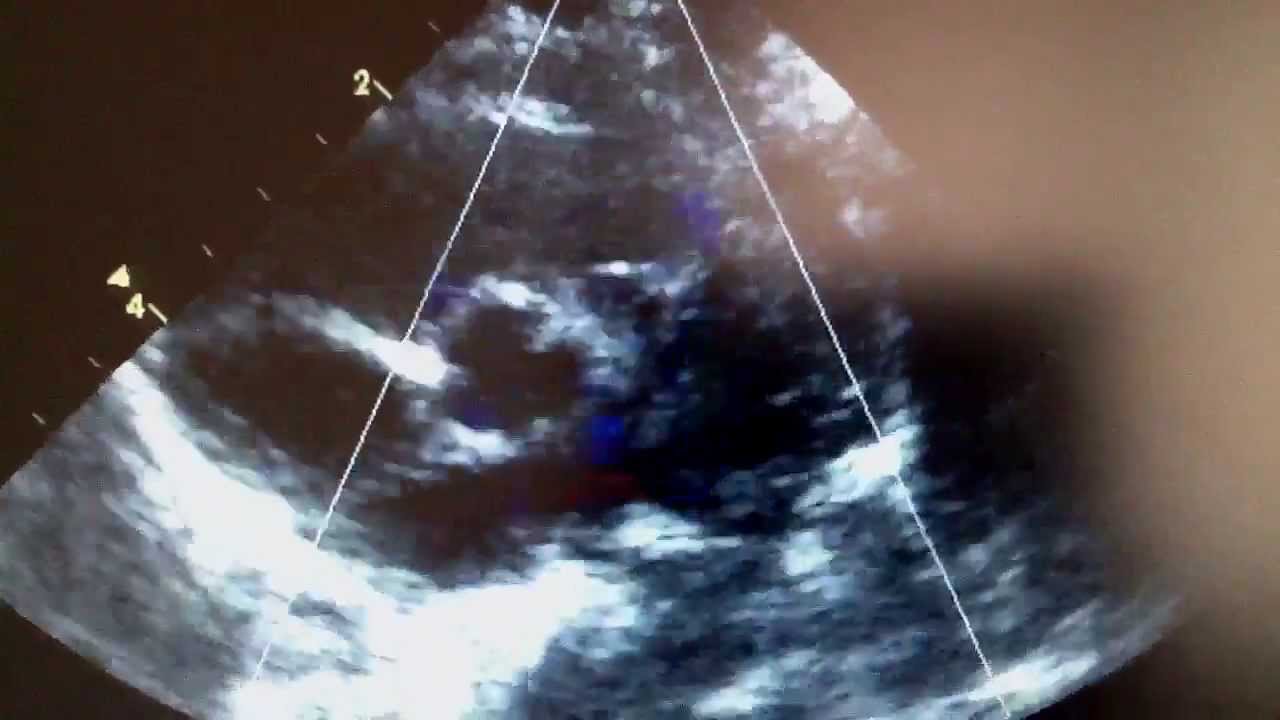 Short axis view Pediatric Echocardiography - YouTube