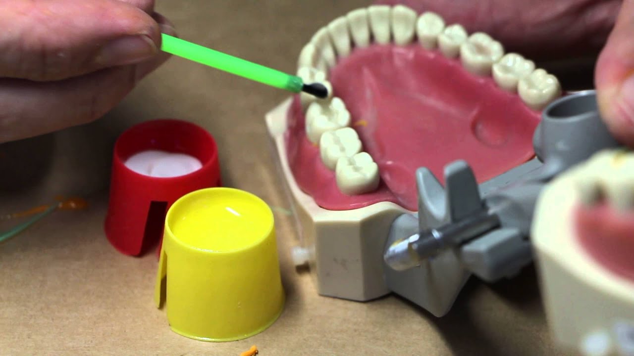 11 Temporizing Your Inlay - YouTube