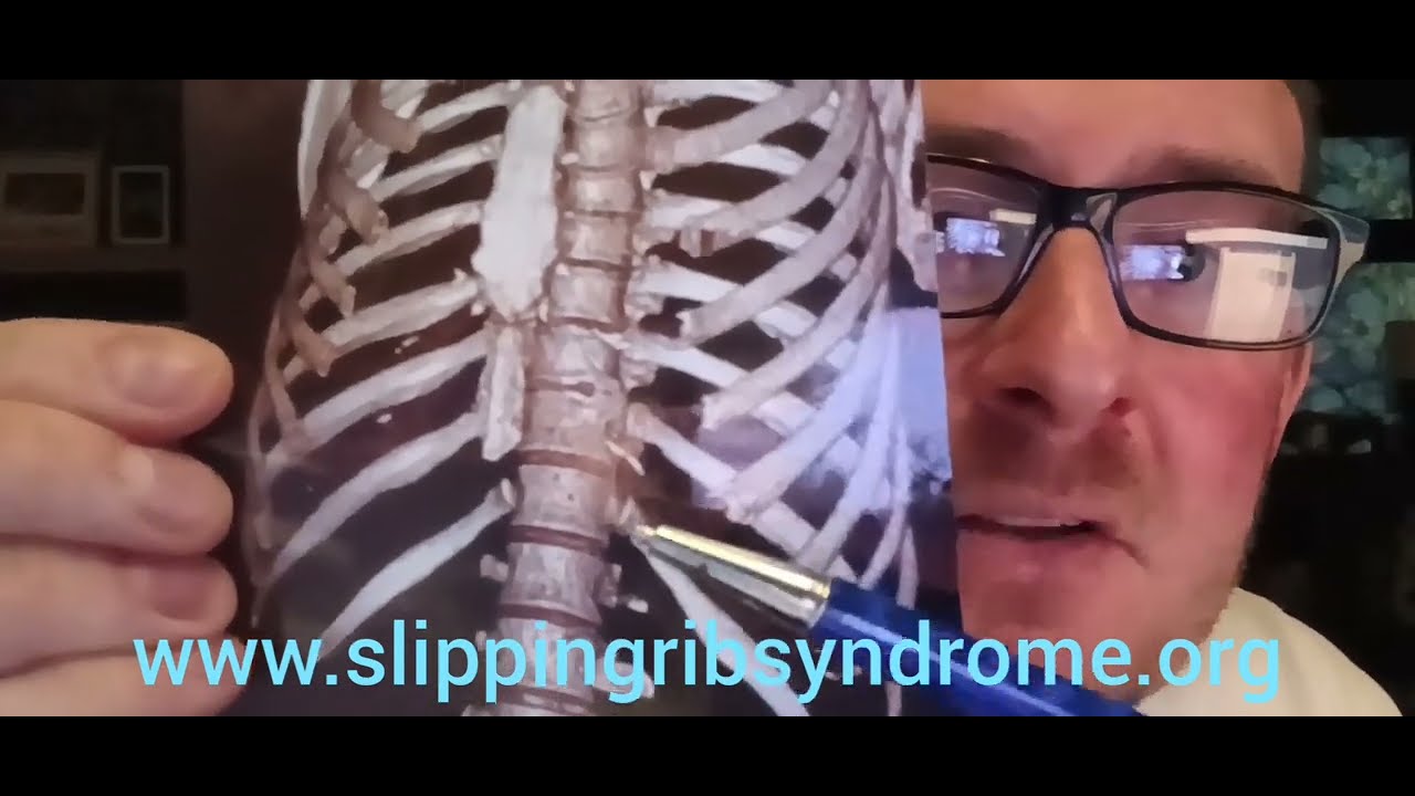 Rib Head Syndrome (Subluxation / Disarticulation at the Costotransverse ...