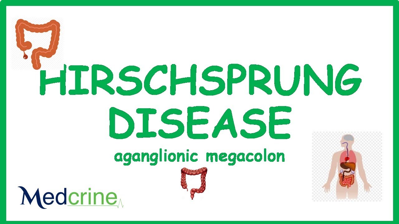 Hirchsprungs Disease (Aganglionic Megacolon) - YouTube