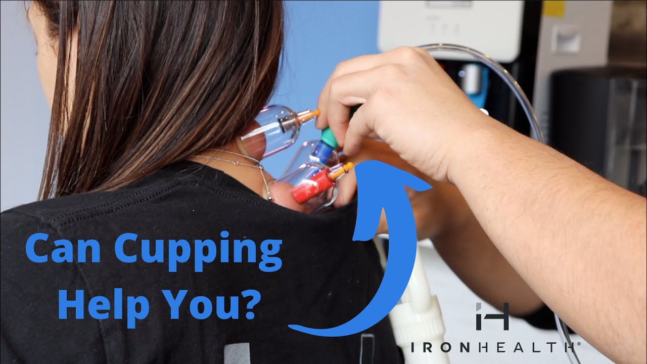 Can you cup neck pain? - YouTube