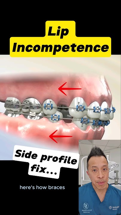 Can Braces Solve Lip Incompetence? How It Achieves Lip Closure # ...
