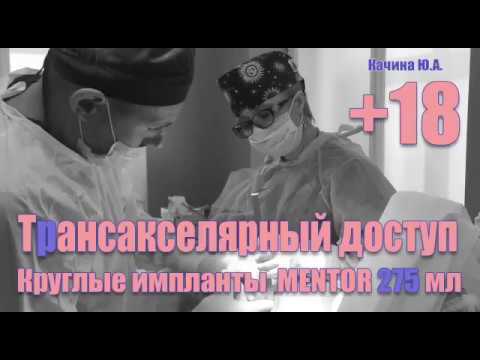 Установка имплантов "Mentor" 275 мл. 18+ - YouTube