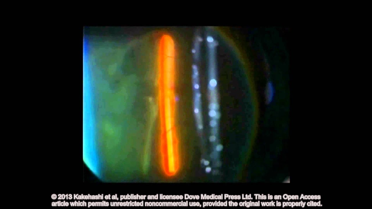 Posterior Vitreous Detachment Slit Lamp