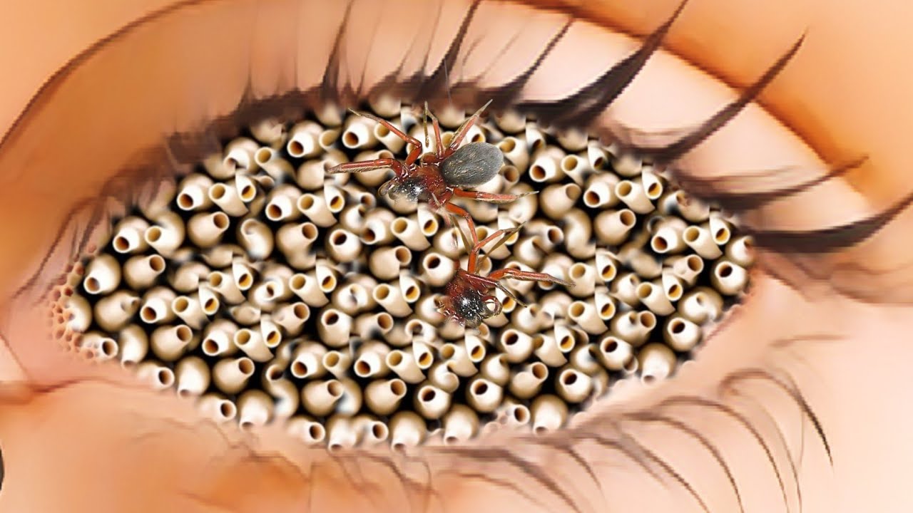 eye maggots clean information asmr - YouTube