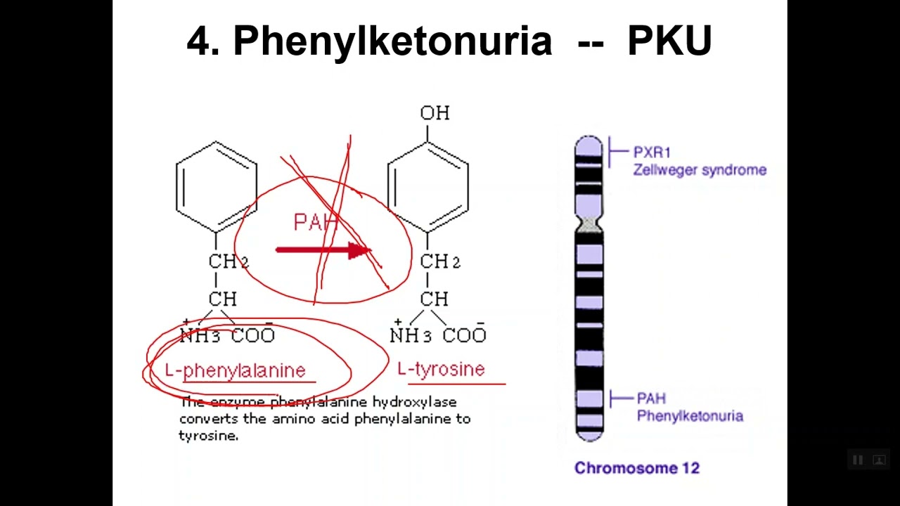 Phenylketonuria Chromosome