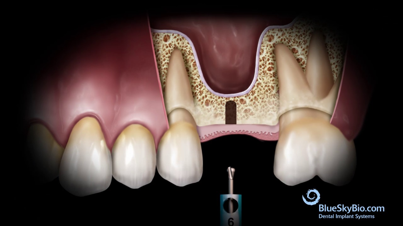 Basic Hammerless Sinus Lift Instrument Technique - YouTube