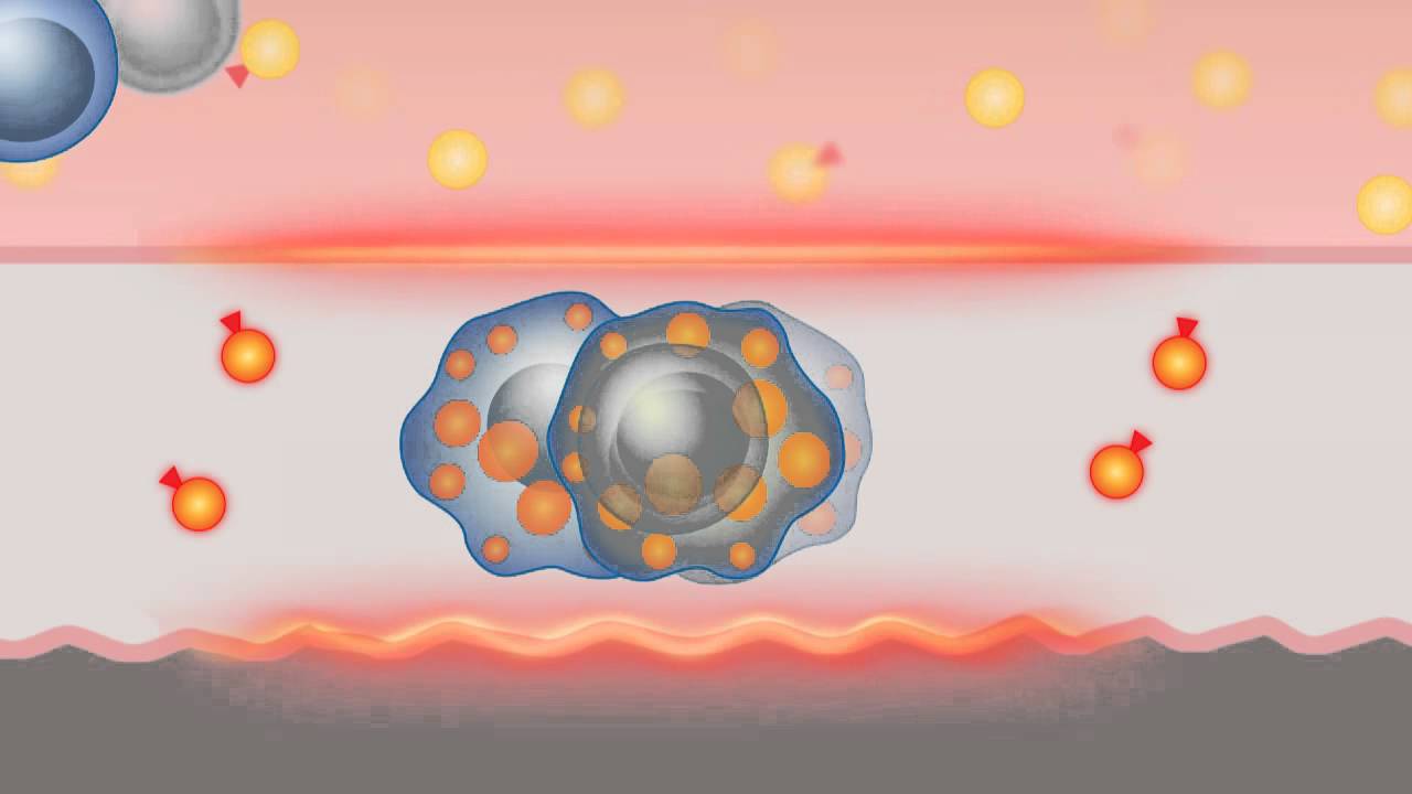 Vulnerable Plaque Test - Medical Animation by Watermark - YouTube