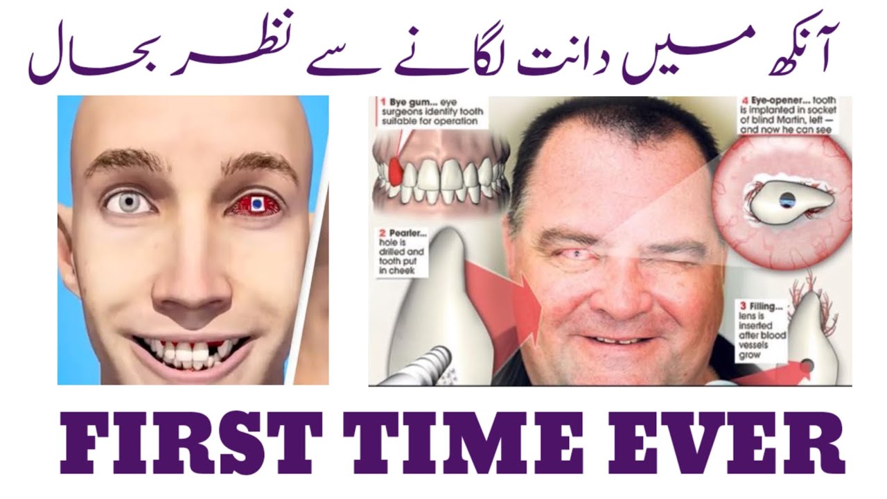 Tooth In Eye Surgery in Urdu/Hindi | How to restore vision with tooth ...