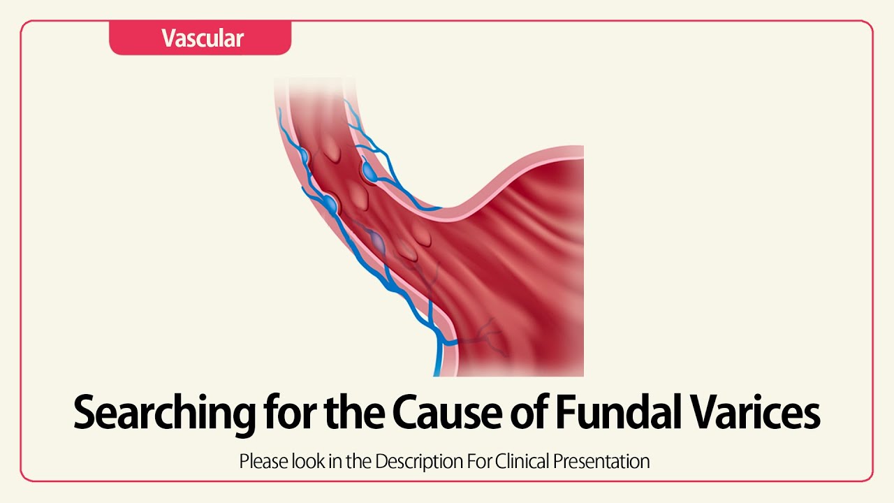 Approach to EUS Fundal Varices - YouTube