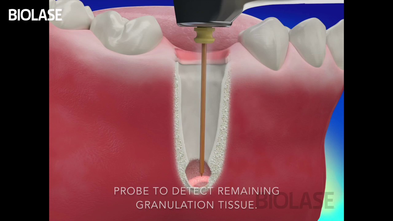 ANIMACE09 Implant socket debridement with Waterlase - YouTube