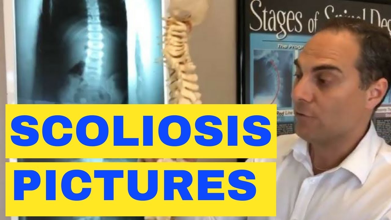 Scoliosis Pictures Photos Scoliosis Picture Scoliosis Pictures In ...