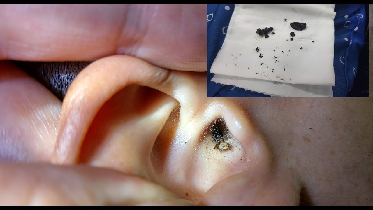 Get too much earwax /Lấy quá nhiều ráy tai - YouTube