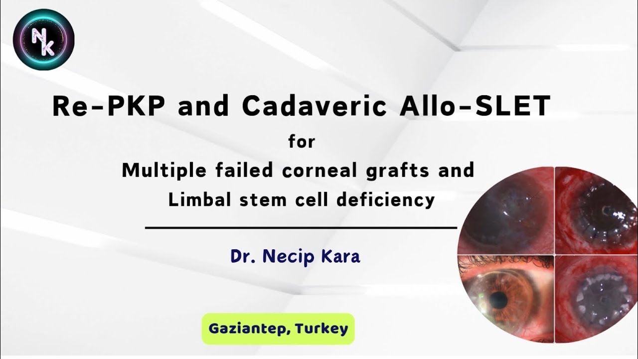 Re-PKP and Allo-SLET for Multiple Failed Grafts and Limbal Stem Cell ...