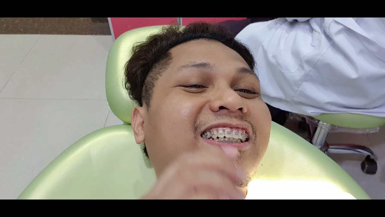 PROCESS OF GETTING BRACES ROAD TO SMILE FOREVER |ADJUSTMENT|PART 3 ...