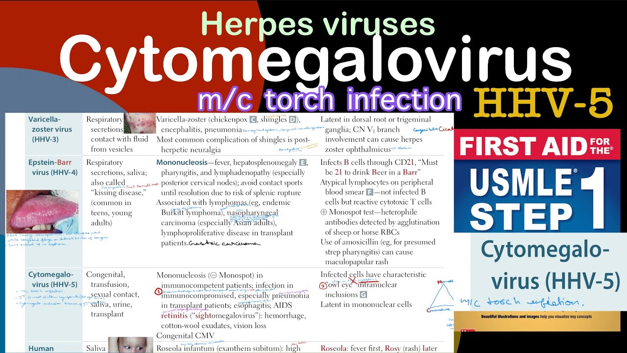 Cytomegalovirus (CMV) most common torch infection in Hindi/Urdu by ...