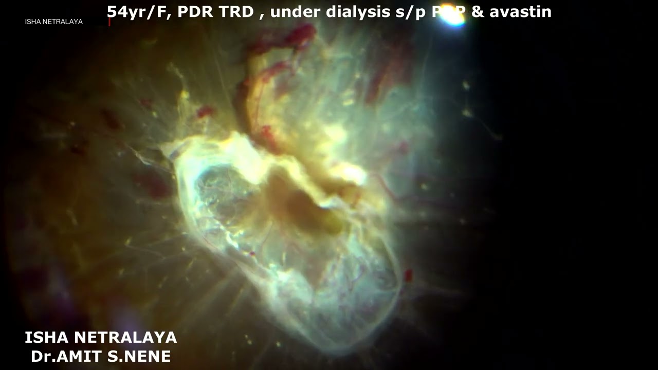 Complicated PDR case-when everything goes as planned!! - YouTube