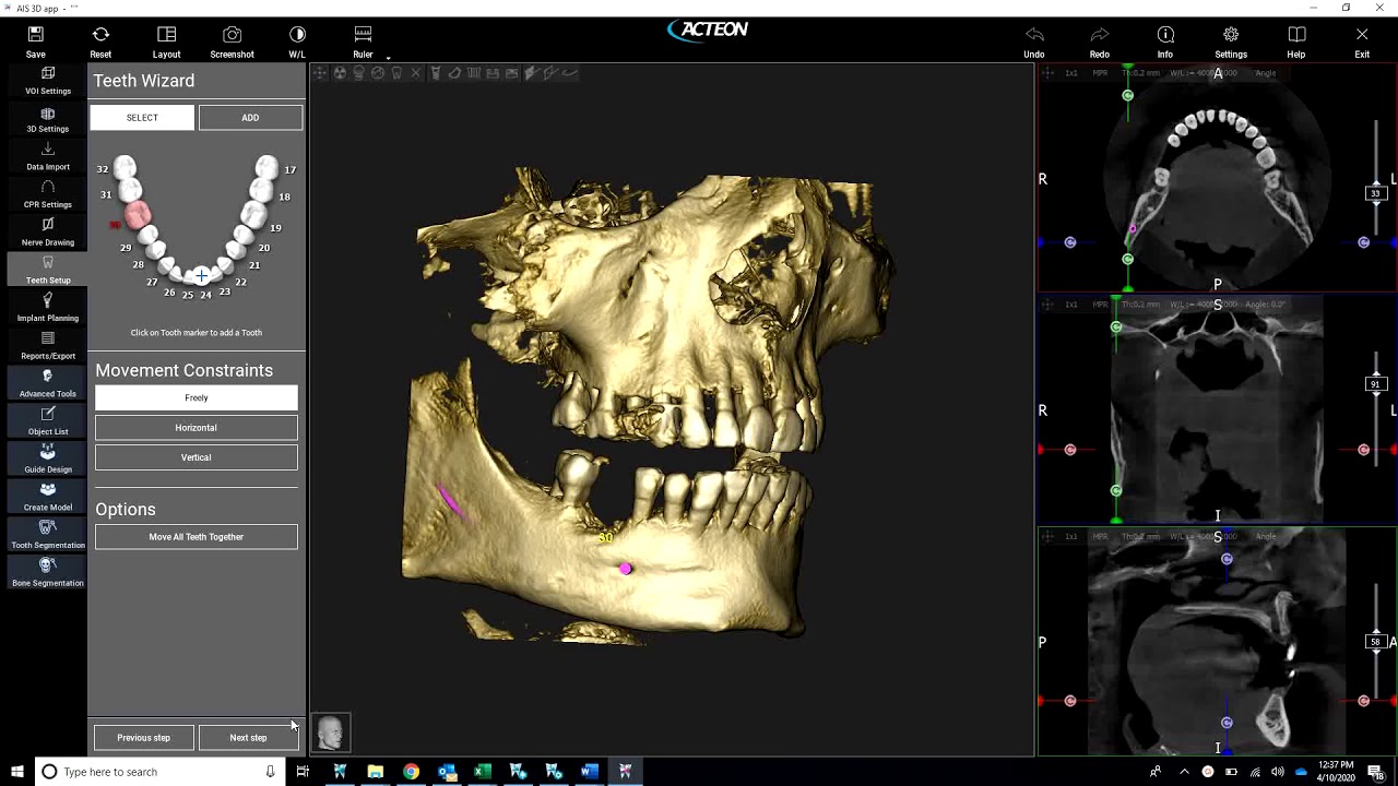 Implant Planning with ACTEON Imaging Suite - YouTube