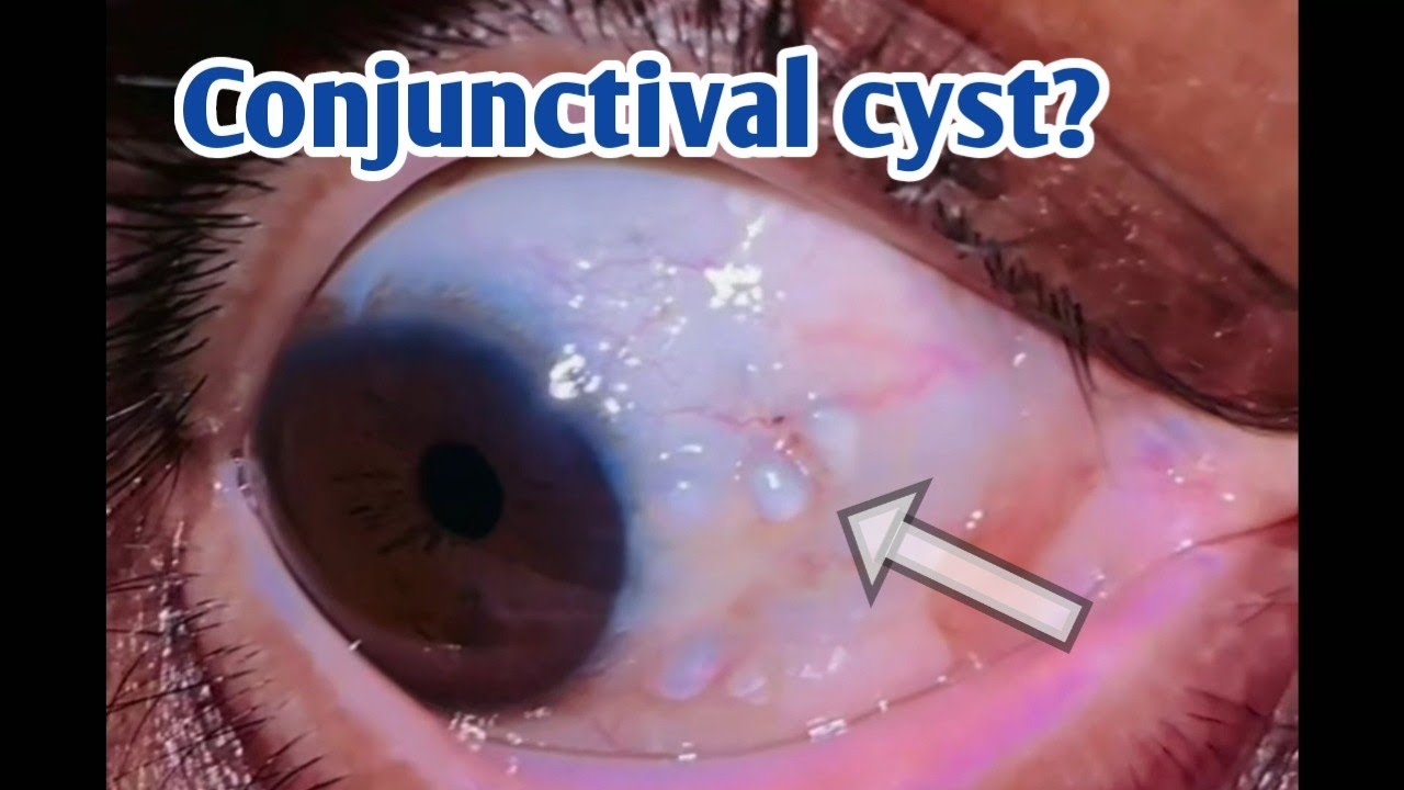 Conjunctival cyst ? condition explained indetail @eyecareoptom5506 # ...