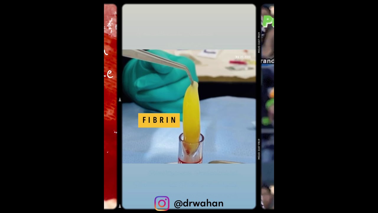 How to Make Sticky Bone Leukocyte Platelet Rich Fibrin L-PRF Intraspin ...