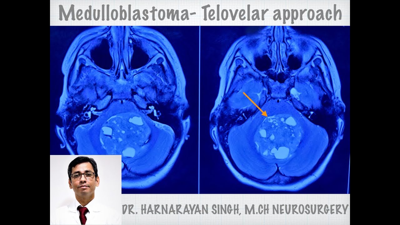 Medulloblastoma Surgery - Telovelar Approach - YouTube