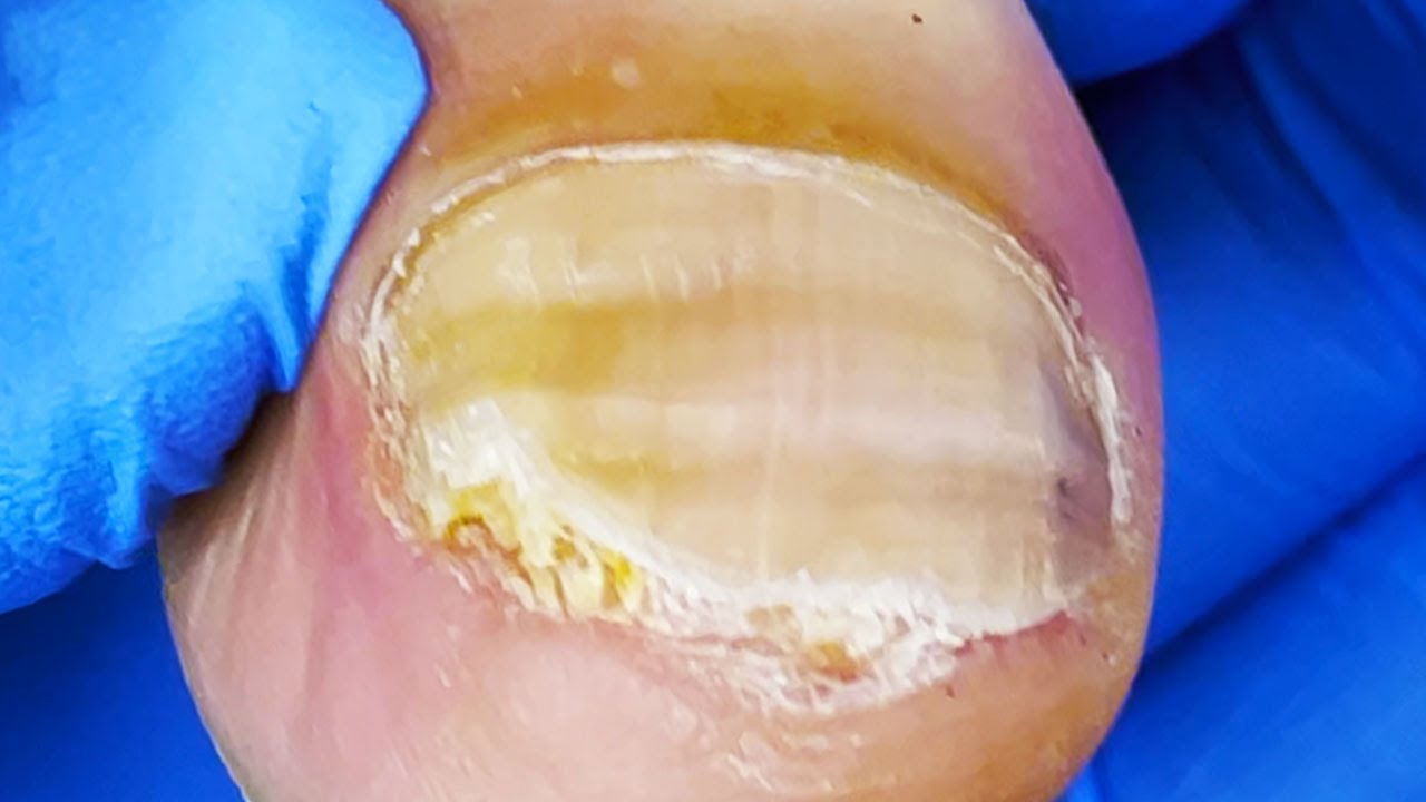 Stinking toenails that haven't been trimmed for too long - YouTube