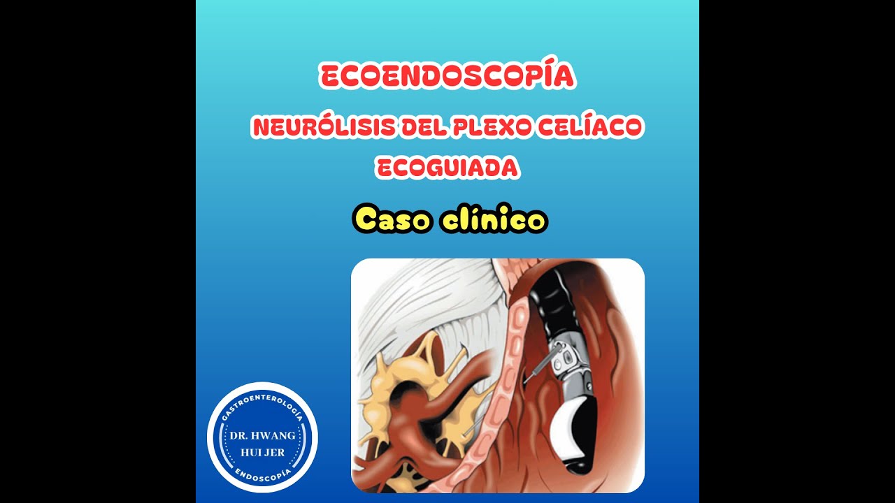Neurólisis del plexo celiaco Ecoguiada - YouTube