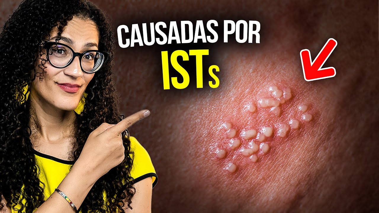 Feridas no Pênis Causadas Por DST/IST - YouTube